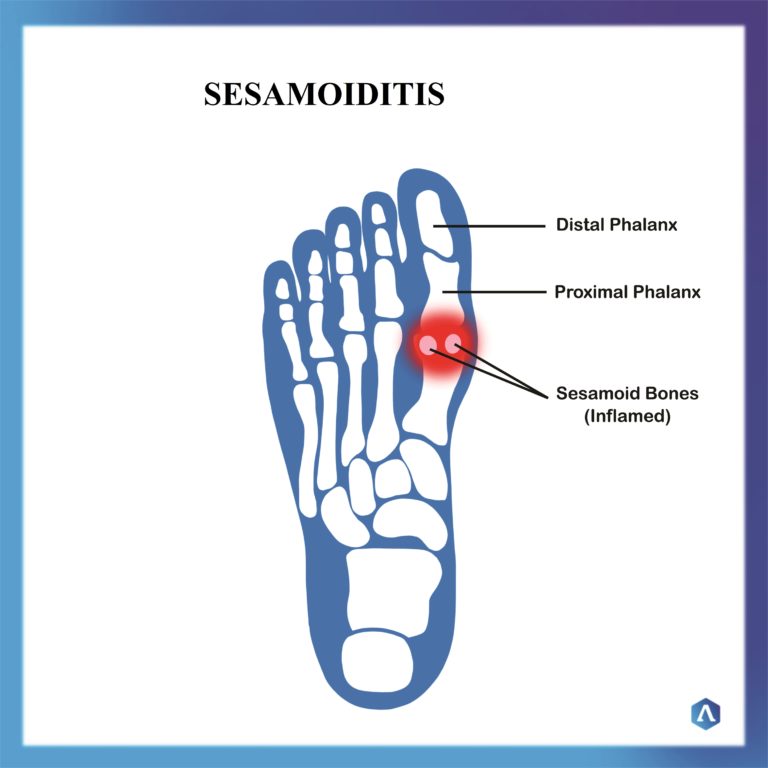 Sesamoiditis | Dr. Abbie Clinics