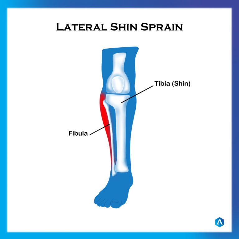 Shin Splint Lateral | Dr. Abbie Clinics